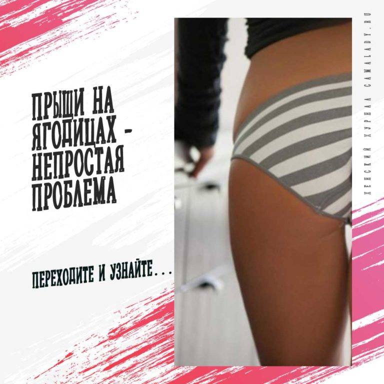 Прыщи на ягодицах – непростая проблема